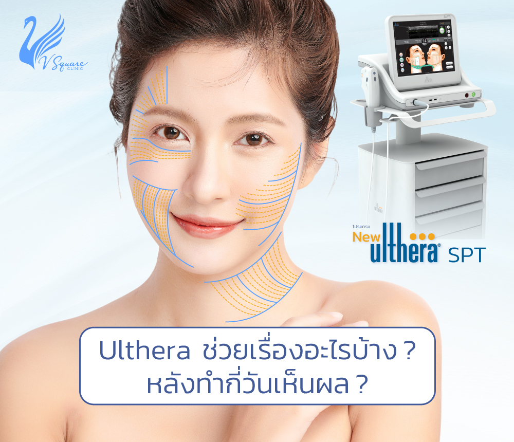 Ulthera คืออะไร ช่วยเรื่องอะไรบ้าง ยกกระชับ ลดริ้วรอย ทำแล้วเห็นผลหรือไม่