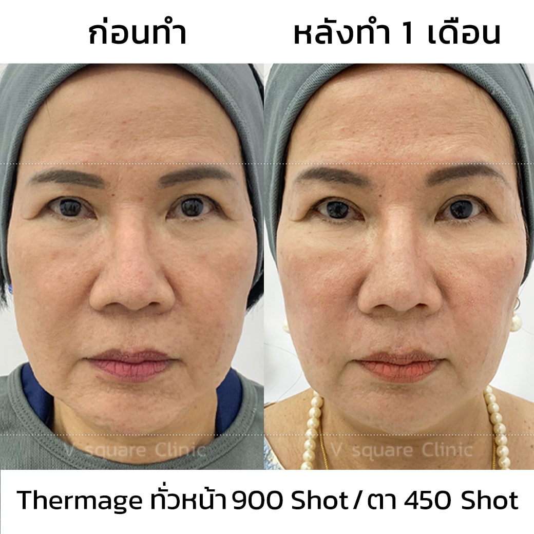 Thermage FLX ยกผิวทั้งใบหน้า ทำกี่ช็อต ราคาเท่าไหร่ ช่วยอะไรได้บ้าง
